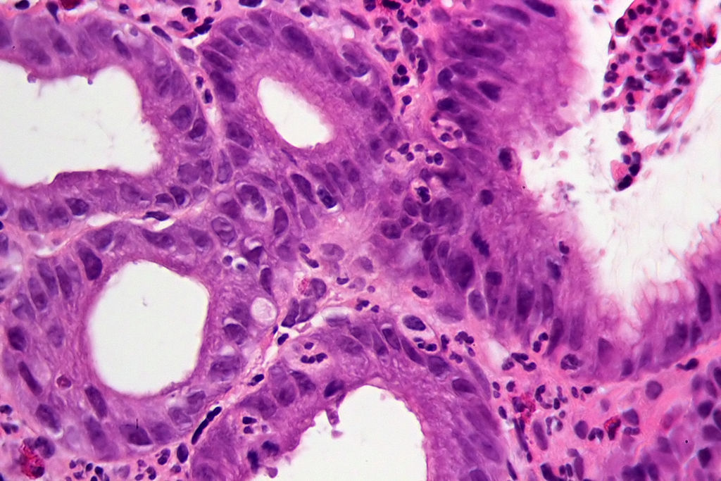 Co to jest helikobakter? Helicobacter pylori - objawy zakażenia ...