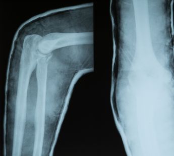 RTG kolana – na czym polega badanie? Wskazania, jak się przygotować