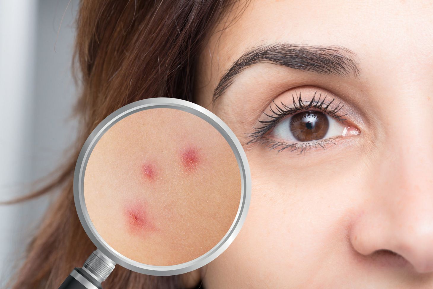 Objawy nużeńca skórnego, ocznego, usznego. Jak leczyć nużycę?