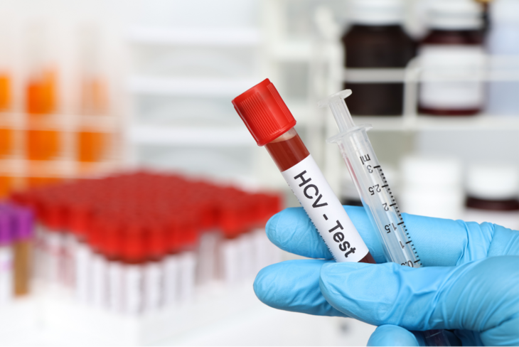 Badanie HCV — na czym polega i kiedy je wykonać? Metody, przygotowanie ...