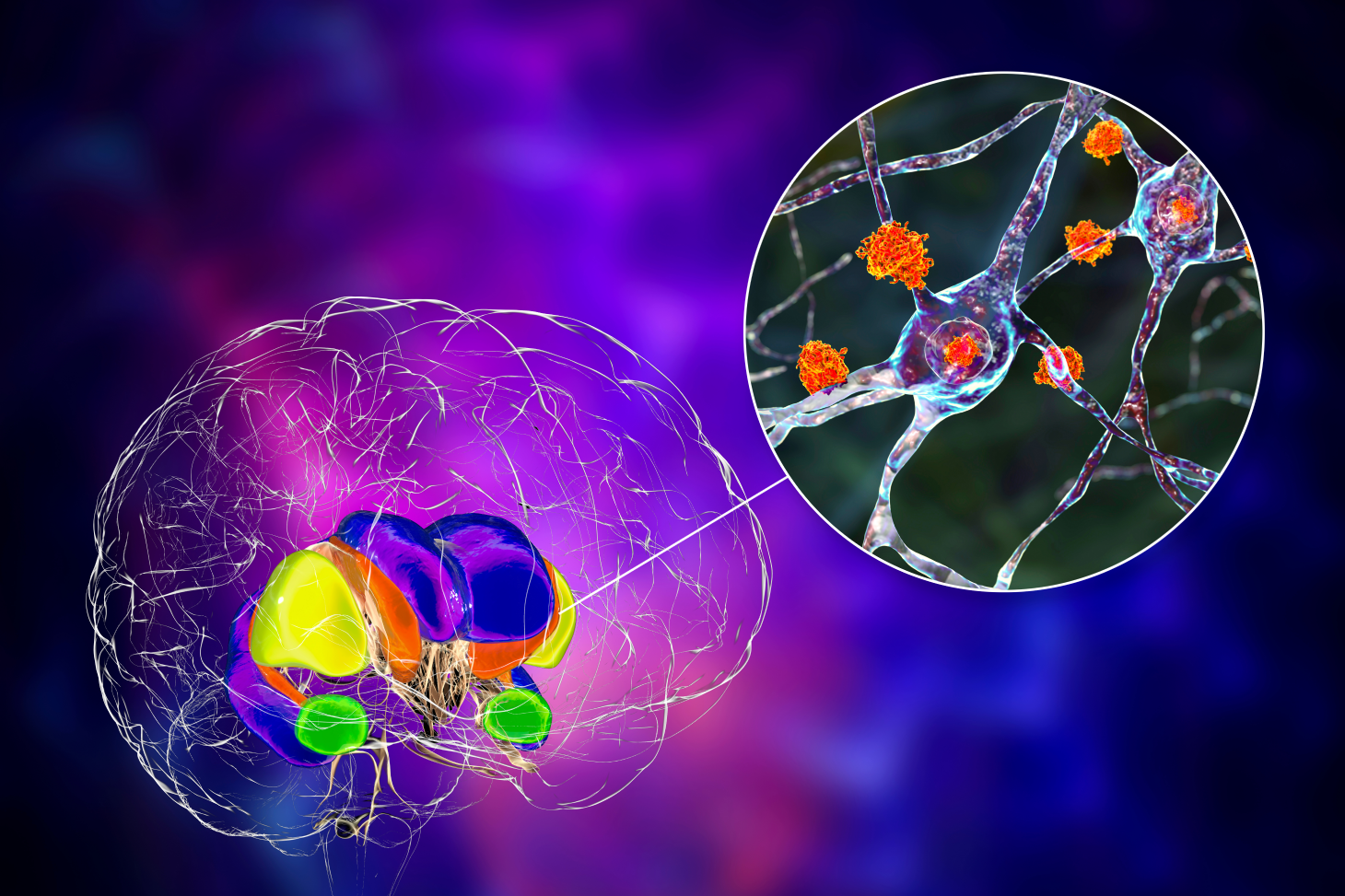 Huntingtonova choroba: huntington krankheit informationen – ICDK